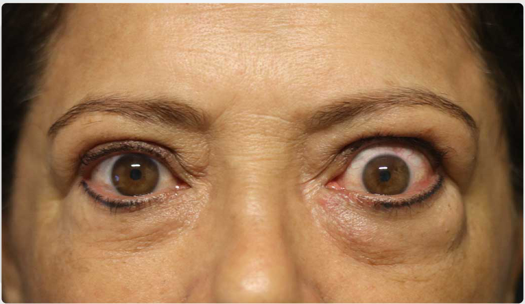 Enfermedad Tiroidea Ocular - Somos Mirada