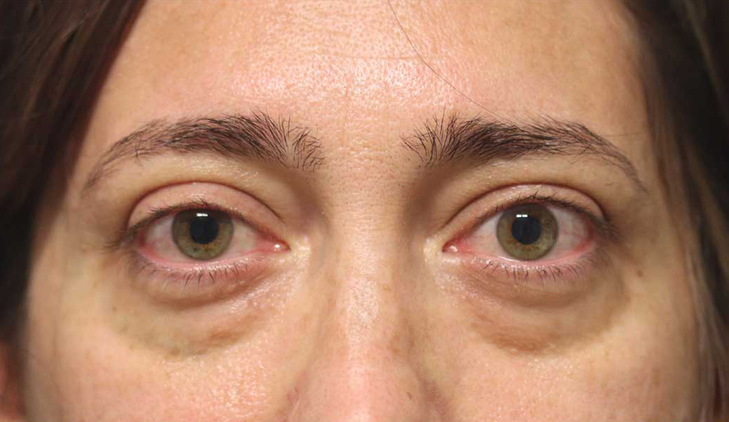 Enfermedad Tiroidea Ocular - Somos Mirada