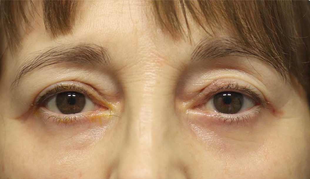 Acquired Ptosis - Somos Mirada